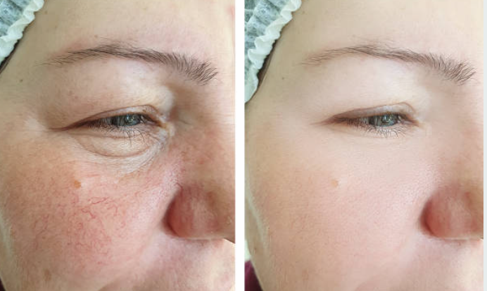 APhen Peel® vs Laser Fotona 5D®: Qual Tratamento Oferece Resultados ...